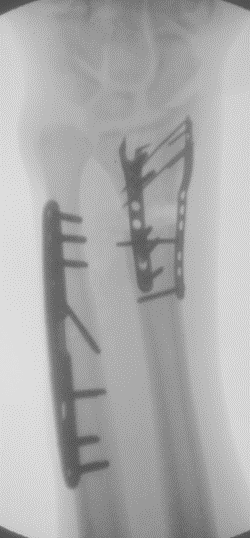 Nonunion/Malunion | John Riehl MD