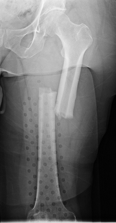 Femoral shaft fracture | John Riehl MD